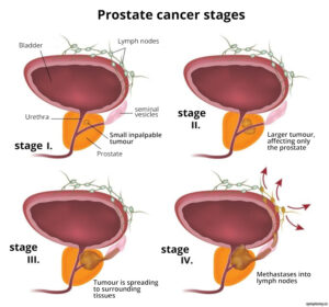 How to understand test results? - All about prostate cancer